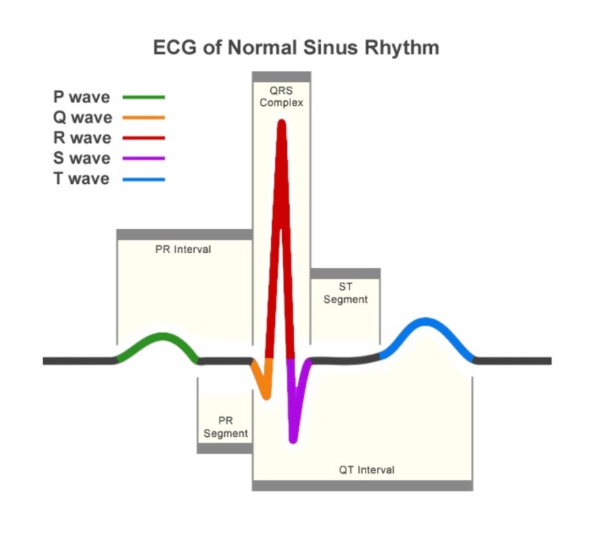 ST Elevation Myocardial Infarction – Medic Minute