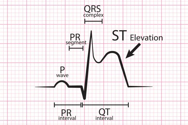 ST Elevation Myocardial Infarction – Medic Minute